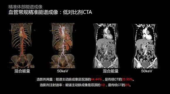 美国GE 精准能谱CT Revolution HD携手AW4.7震撼亮相投入使用 - 漯河市召陵区人民医院