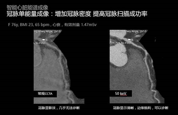 美国GE 精准能谱CT Revolution HD携手AW4.7震撼亮相投入使用 - 漯河市召陵区人民医院