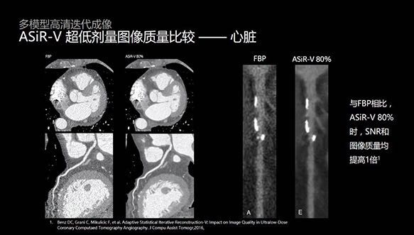 美国GE 精准能谱CT Revolution HD携手AW4.7震撼亮相投入使用 - 漯河市召陵区人民医院